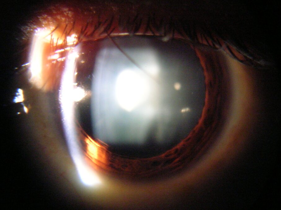 Clouded vision - Southern Eye Specialists